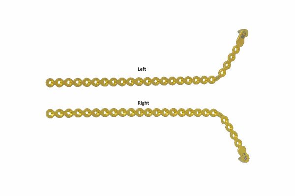 Titanium ultralock® mandibular Reconstruction Plates with TMJ Condyle ...